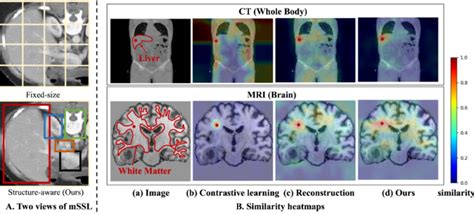 논문 리뷰 Structure Aware Semantic Discrepancy And Consistency For 3d Medical Image Self