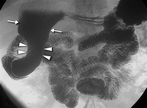 Annular Pancreas Barium