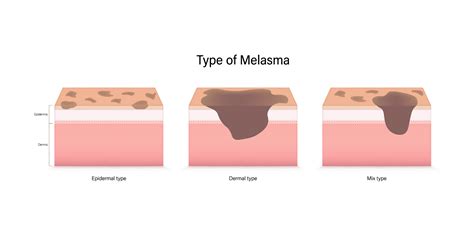 Melasma Disease Background Mims Philippines
