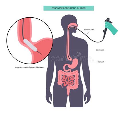 Endoscopic Pneumatic Dilation Stock Vector Illustration Of Invasive