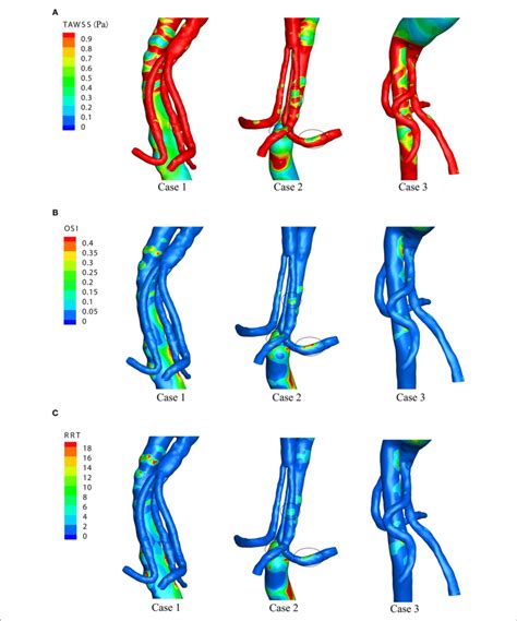 The Time Averaged Wall Shear Stress Tawss Oscillatory Shear Index