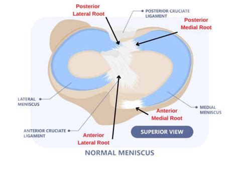 Meniscus Root Tear Knee Specialist Los Angeles Orange County Ca