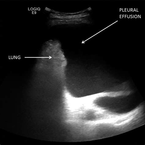 Time To Focus ‘palliative Medicine Point Of Care Ultrasound Indian