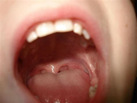Les plaies dans la bouche cicatrisent jusqu à trois fois plus vite que