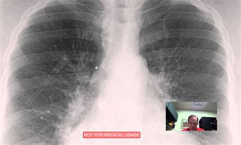 Cxr Pulmonary Vascular Congestion Discussed By Radiologist Mp4 Youtube