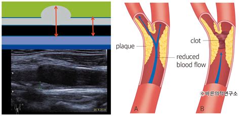 경동맥 초음파 Carotid Ultrasonography Metamedic