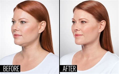 Botox Injections For Double Chin Telegraph