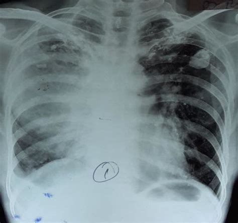 Baseline Chest X Ray Showing Right Sided Ill Defined Consolidation With