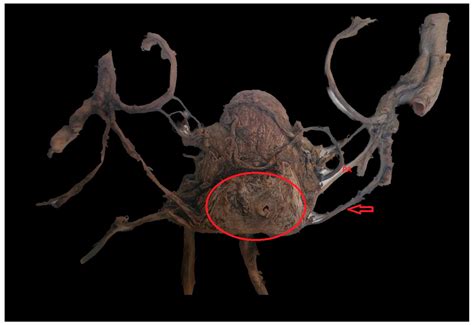 Prostatic Artery Origin Variability Five Steps To Improve