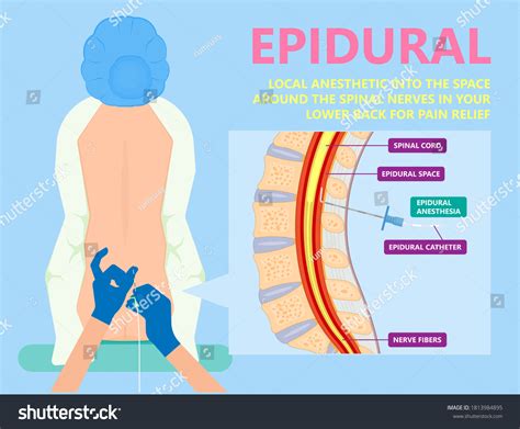 Intrathecal Vs Epidural Injection