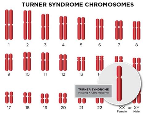 Monosomy X Turner Syndrome Diagnosis And Treatment