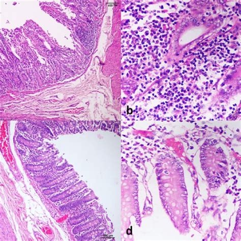 Histopathological Observations A Mucosal Ulceration And Focal