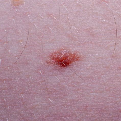 Nevus Or Mole On The Human Body Close Up Skin Cancer Keratosis Or