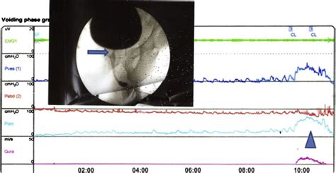Primary Bladder Neck Dysfunction In A 46 Year Old Man With Chronic Download Scientific Diagram