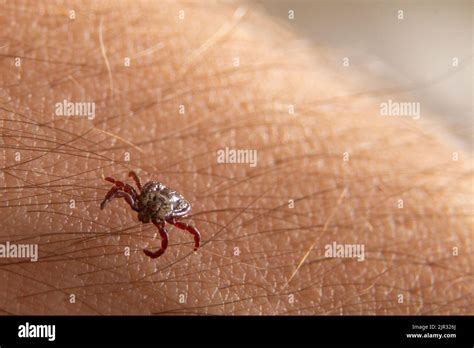 Crawling Deer Tick On The Background Of Human Hairy Skin Dangerous