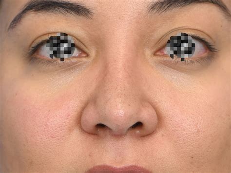 Before And After Rhinoplasty Houston Face Forward