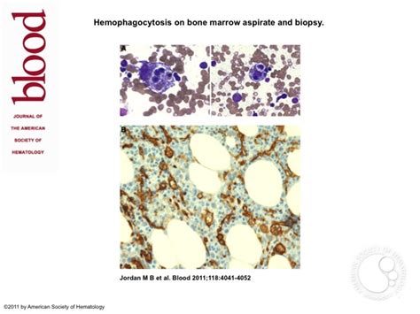Hemophagocytosis On Bone Marrow Aspirate And Biopsy