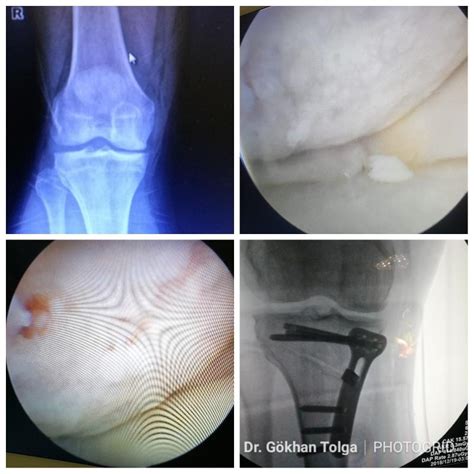 Gokhan Tolga Akbulut On Linkedin 42 Y Medial Tibiofemoral