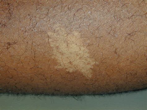Ash Leaf Macule In Human Skin Biological Science Picture Directory