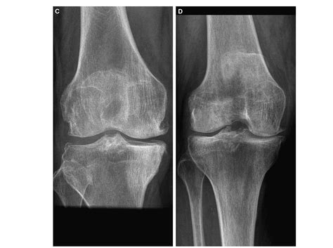 Knee A Normal B Medial Tibial Attrition C Medial