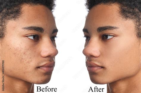 African American Teenage Boy Before And After Acne Treatment On White