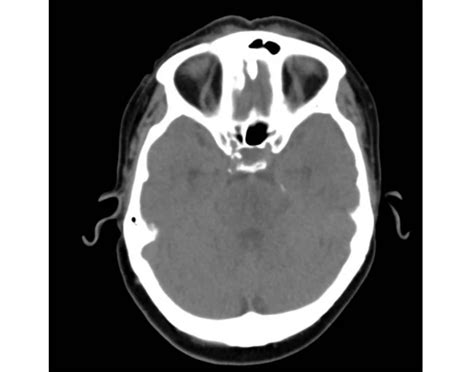 Ct Head Axial Anatomy Quiz