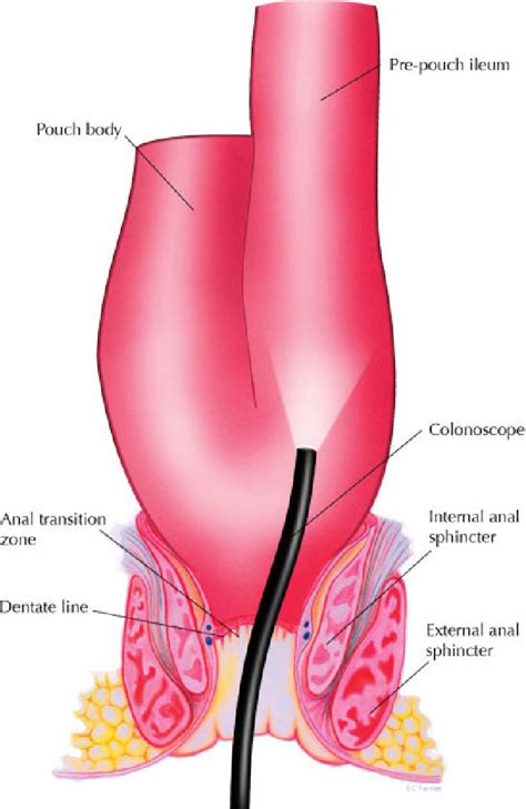 Figure 1 From Guide To Endoscopy Of The Ileo‐anal Pouch Following
