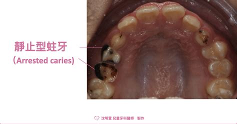 兒童牙醫沈明萱 牙齒黑黑的，代表蛀牙很嚴重？且慢，先檢查是不是靜止型蛀牙