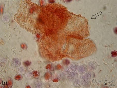 Caso UR Noviembre 12 Enfoque Proceso Infeccioso