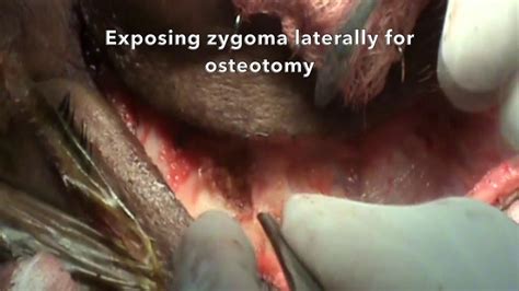 Maxillectomy Video Youtube