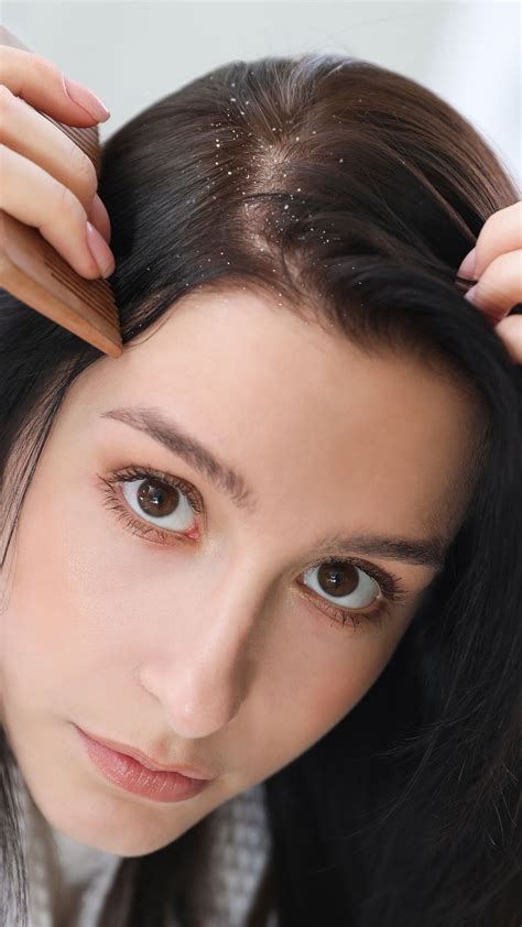 Winter Haircare 6 Natural Remedies To Get Rid Of Dandruff