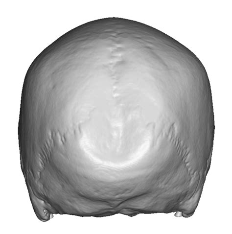 Skull Reshaping Archives Explore Plastic Surgery