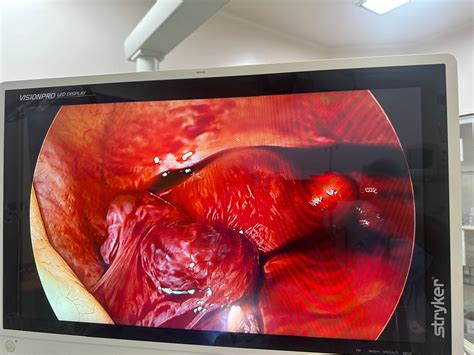 Best Laparoscopic Surgeon For Ectopic Pregnancy In Kolkata