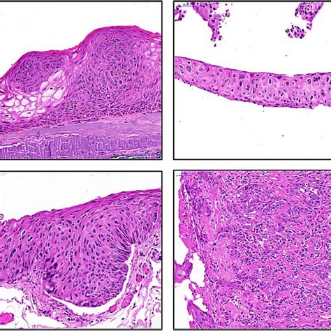 Ossn Specimens With Different Involvement Of Dysplasia Ossn Samples