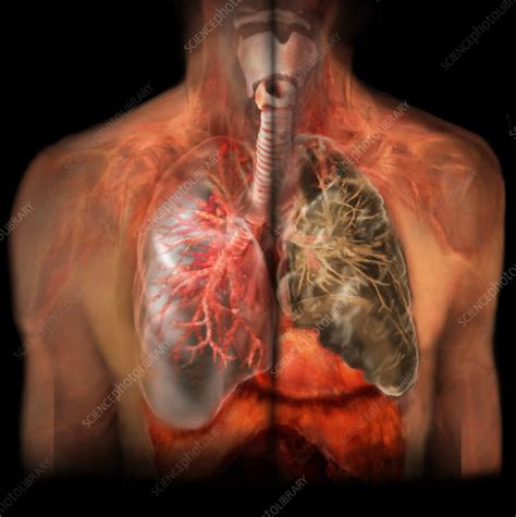 Healthy Lung Vs Smokers Lung Stock Image C0383695 Science Photo Library