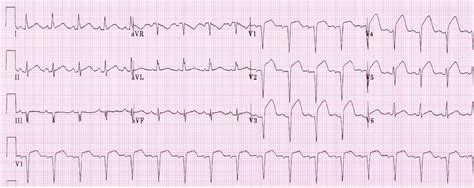 Study Medical Photos Acute Anterior Myocardial Infarction Ecg The