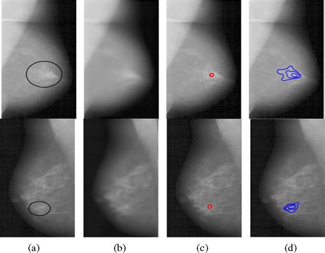 Detection Results Of Malignant Cases A Original Image B