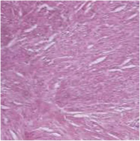 Microscopic Appearance Of Scrotal Leiomyoma Note The Bland Looking