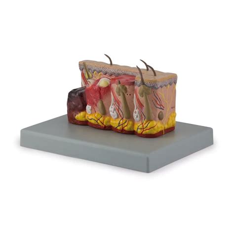Buy Pathological Model Of Burnt Skin 30x Life Size Anatomical Model