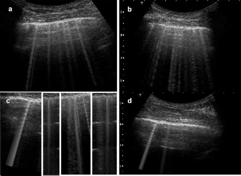 B Lines In Patients With Cardiogenic Pulmonary Edema A And B