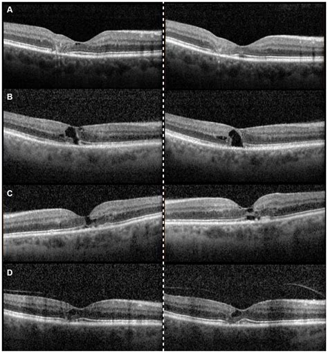 representative examples of ellipsoid zone ez loss on spectral domain