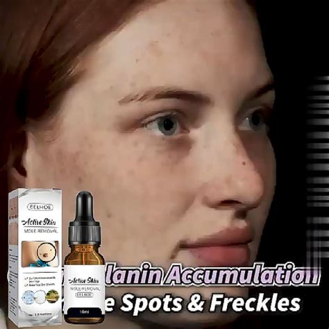 Mole Remover Essence Warts Remover Original Effective Mole And Warts