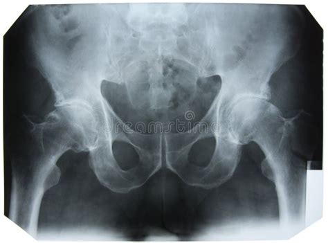 Radiografía de la pelvis imagen de archivo Imagen de backbone 24206835