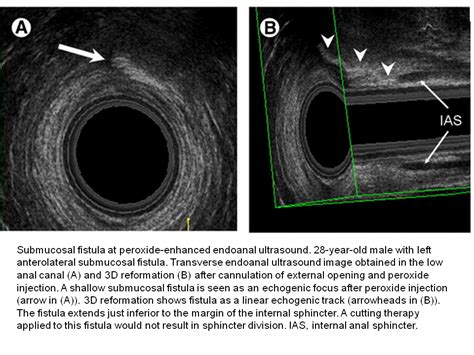 BÀI SOẠN VỀ SIÊU ÂM CHẨN ĐOÁN Anal and Rectal Endosonography in Clinical Practice