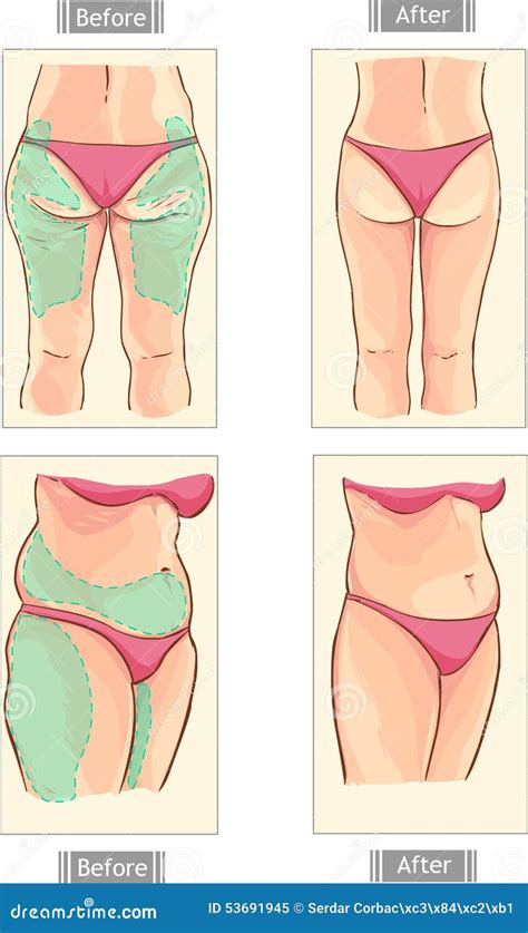 Liposuction Stock Vector Illustration Of Hide Health