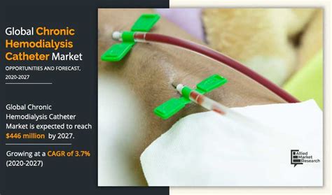 Chronic Hemodialysis Catheter Market Size And Growth Report 2027