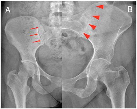 Sacroiliac Joint Space Narrowing