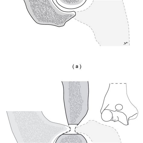 Schematic Drawing Of The Impingement Of The Coronoid Process And The