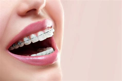 Brackets Transparentes Clinica Dental Sonrisa Segura