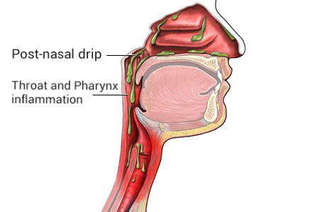 How To Reduce Post Nasal Drip Possibilityobligation5
